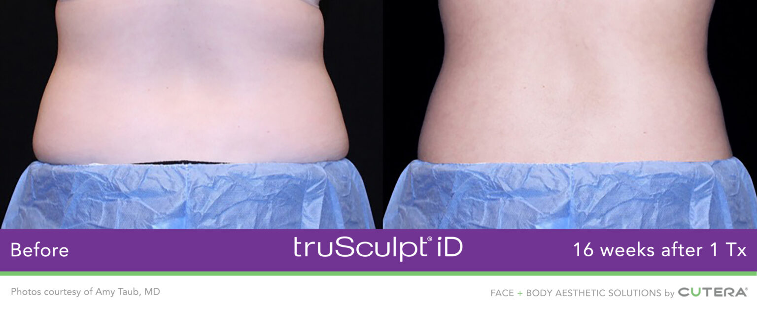 TruSculpt iD Woodlands TX - Body Contouring Conroe TX