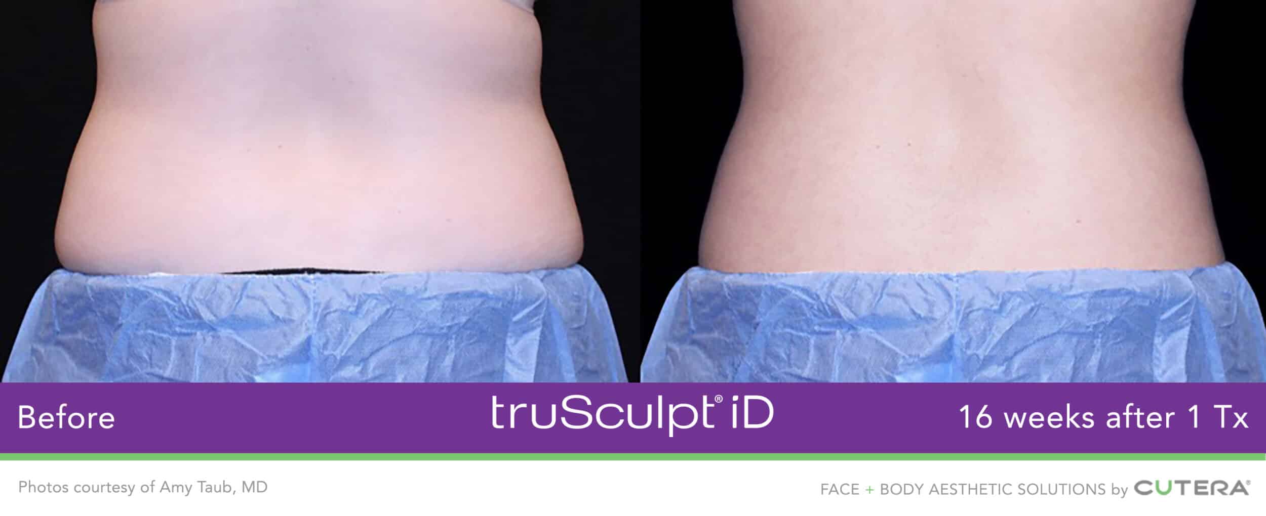 Trusculpt Id Woodlands Body Contouring Tamina Tx
